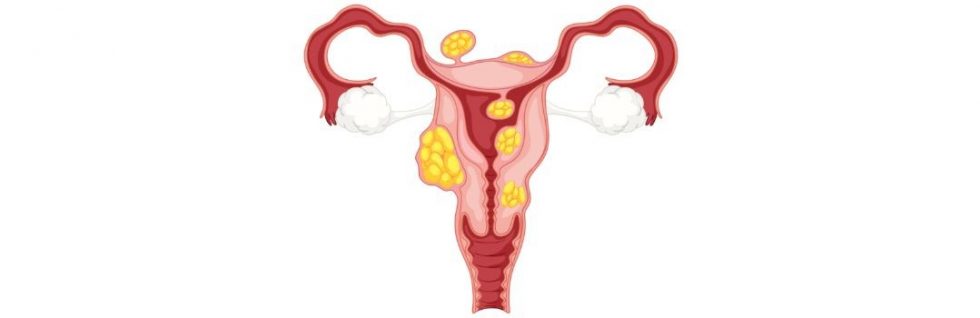 Uterine Fibroid Size: How Big Is Too Big | Shree IVF Clinic