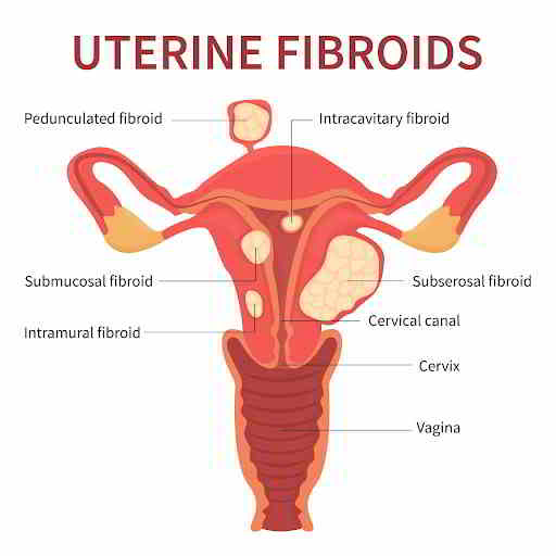 How Is Endometriosis Different From Fibroids