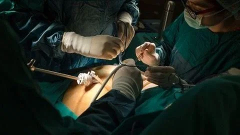 laparoscopic myomectomy procedure code